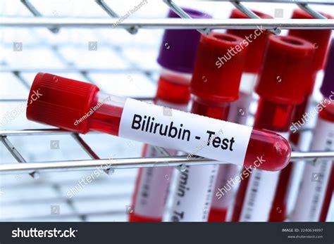 Bilirubin Test Look Abnormalities Blood Blood Stock Photo 2240634897 Shutterstock