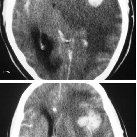Axial Brain Ct Scan Without Contrast Shows A Heterogeneous Hyperdense Download Scientific