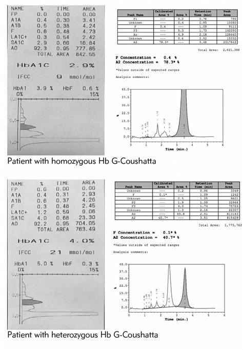 Ion Exchange HPLC Chromatogram For HbA1c And Hb Variants Analysis Of Download Scientific