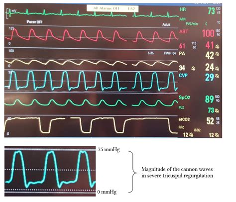 Abnormal Central Venous Pressure Waveform Patterns Deranged Physiology