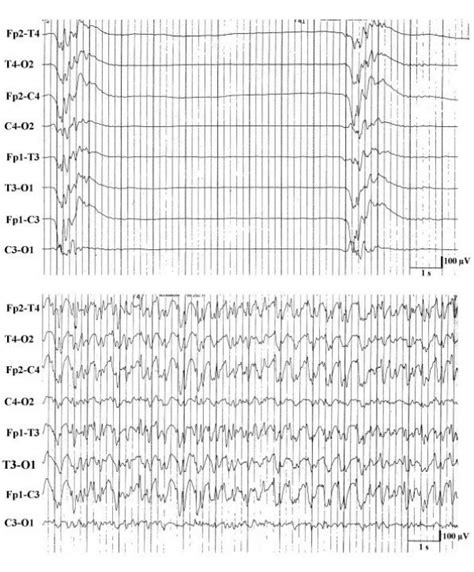 Burst Suppression Eeg Upper Recording With Periods Of Continuous Download Scientific Diagram
