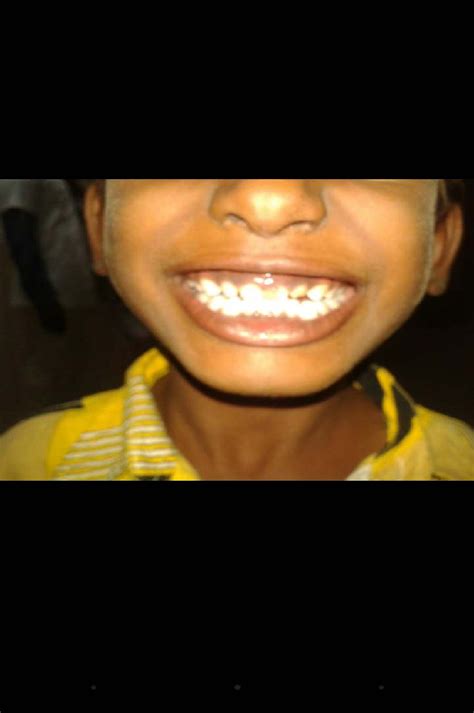 Figure 3 From An Incomplete Ectrodactyly Ectodermal Cleft Syndrome A Case Report Semantic