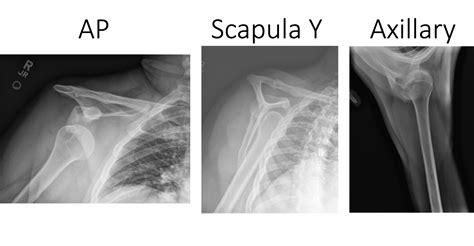 Shoulder X Ray Series At Kenneth Locke Blog
