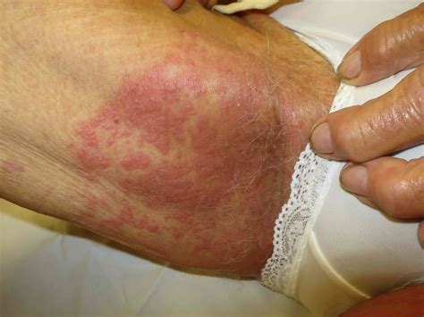Rash On Inner Thigh 12 Causes And Treatments For Women