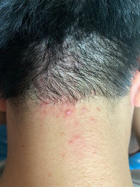 뒷목 피부 트러블 지식in