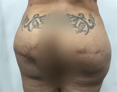 Aftermath Of Illegal Buttock Injections Rbotchedsurgeries