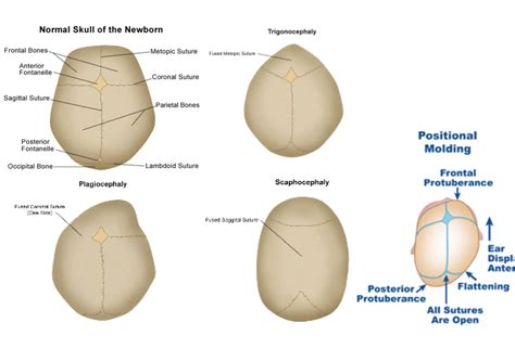 Craniosynostosis Philomed