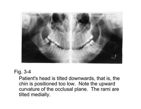 Positioning Errors In Panoramic Radiography Ppt