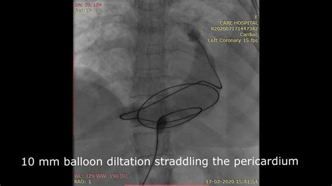 54 F Lung Malignancy Recurrent Pericardial Effusion Too Frail To