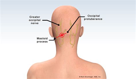 Cluster Headaches Occipital Nerve At Brittany Wertz Blog