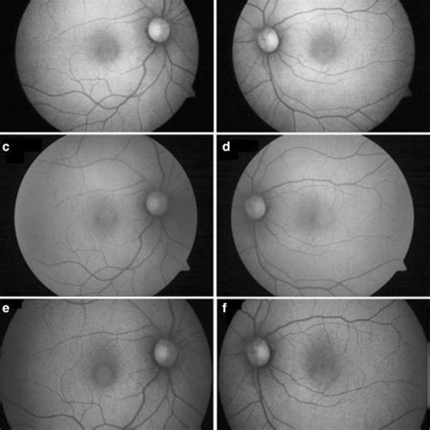 Serial Humphrey Visual Field 24 2 Total And Pattern Deviation Plot At