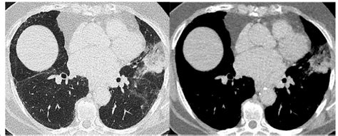 Follow Up Tct Scan In 2018 Showing Lingular Consolidation With Download Scientific Diagram