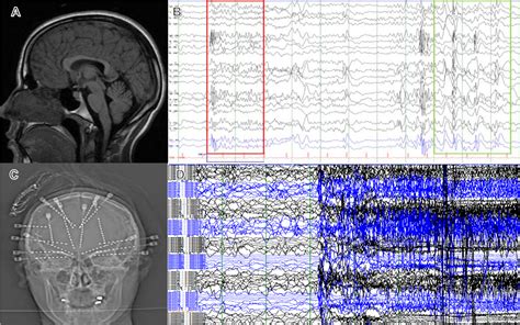 Centromedian Thalamic Responsive Neurostimulation For Lennox‐gastaut