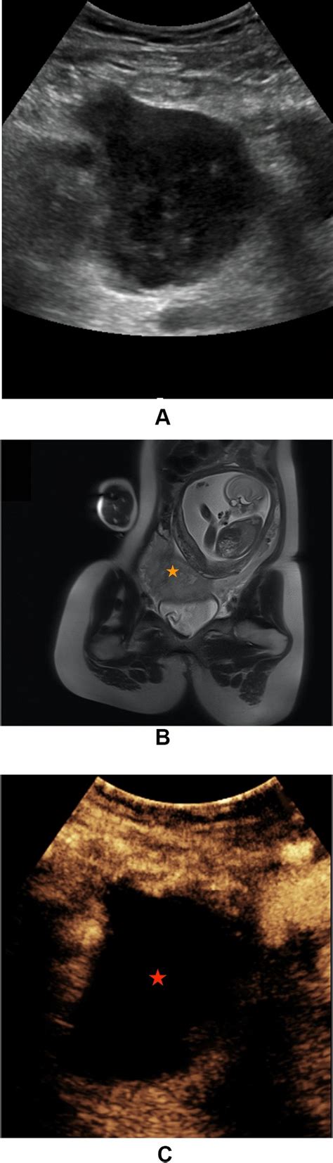 Retroperitoneal Bleed Ultrasound 145 Left Malignant Germ Cell Tumor Of