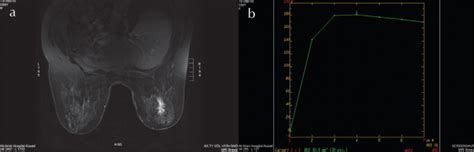 Left Breast Spiculated Mass With Ill Defined Margin Heterogeneous Download Scientific Diagram