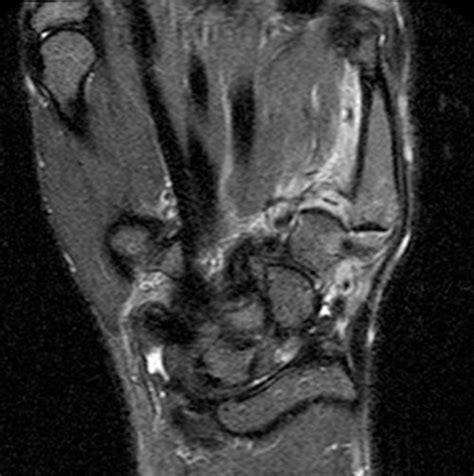 Thumb Cmc Joint