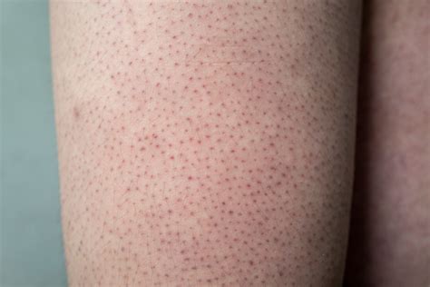 Strawberry Legs Causes And How To Get Rid Of Them Watsons Malaysia