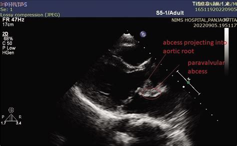 Infective Endocarditis Aortic Root Abscess Indian Journal Of Cardiovascular Disease In Women