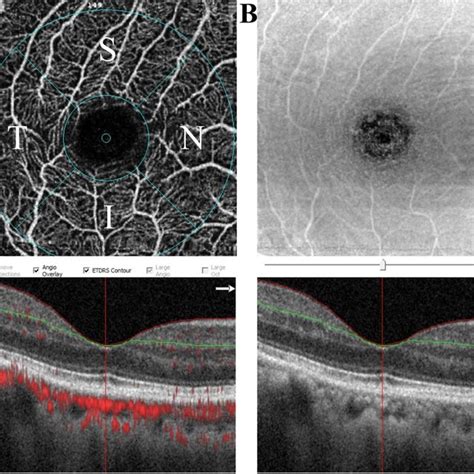Determination Of Retinal Vessels By Optical Coherence Tomography