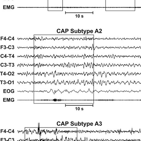 Top Panel Cyclic Alternating Pattern Cap Subtype A1 Slow