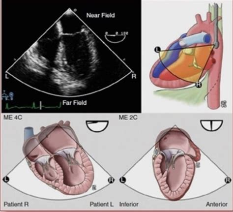 Echocardiogram Flashcards Quizlet
