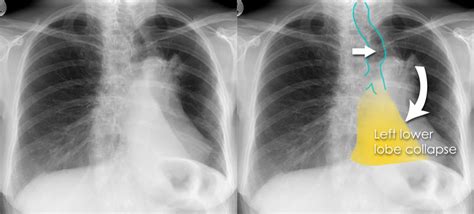 Collapsed Lung X Ray