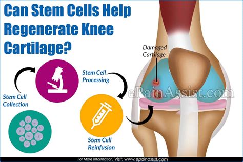 Can Stem Cells Help Regenerate Knee Cartilage