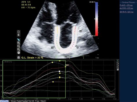 Example Of Speckle Tracking Echo Derived LA Strain Regional Strains Download Scientific