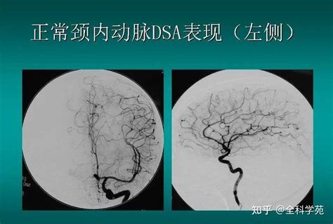 如何阅读脑血管dsa 知乎