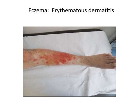 Varicose Vein And Venous Ulcer Prof Ripptx