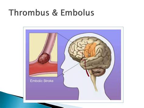 Arterial And Venous Embolectomy PPTX Blood Disorders Diseases And Conditions