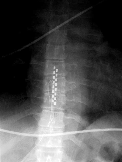 Postsynaptic Dorsal Column Spinal Cord Stimulation Golfbars