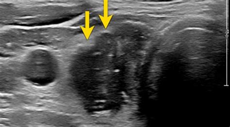 The Radiology Assistant Ti Rads Thyroid Imaging Reporting And Data System