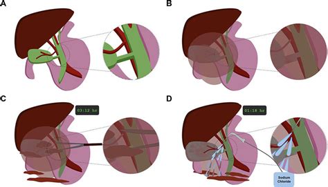 Examining Cholecystectomy Techniques A Non Gangrenous Gallbladder