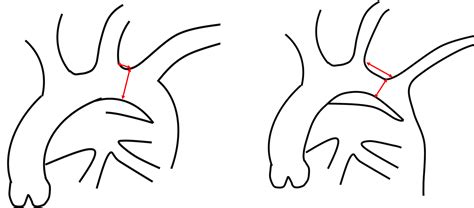 Fetal Coarctation Of Aorta Predicting The Unpredictable Fetal Cardiac Care