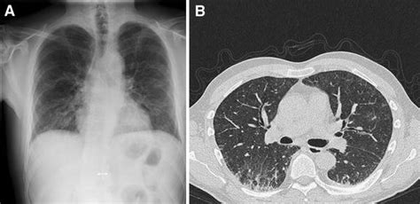 A Chest X Ray With Diffuse Bilateral Interstitial Pattern B A Chest X Ray With Diffuse Bilateral Interstitial Pattern B