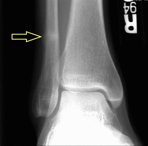 Everything About Fibula Stress Fracture Sport Doctor London