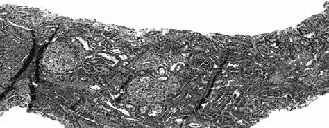 Eleven Glomeruli With Mild Lobulation And Mesangial Hypercellularity Download Scientific
