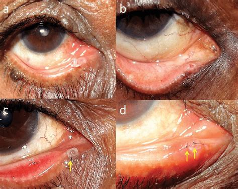 A A Spontaneously Extruded Mls In A Patient With Canalicular