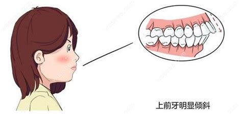 亲戚家孩子骨性龅牙做了早期干预矫正 没想到效果这么好 口腔资讯 牙齿矫正网