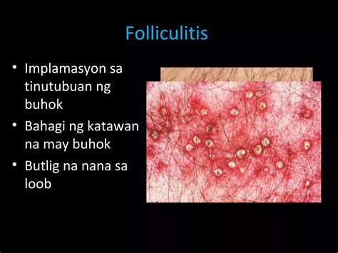 Mga Sakit Sa Balat Sanhi Ng Bacteria Ppt