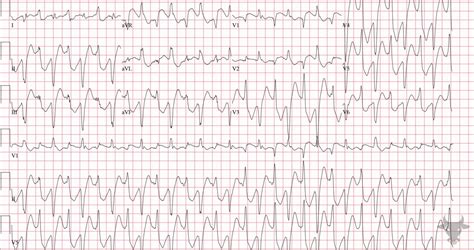 Polymorphic Ventricular Tachycardia Ecg Stampede