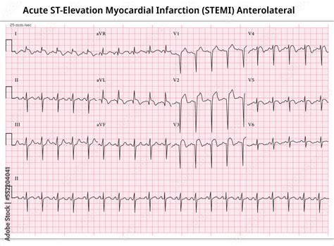 Acute St Elevation Myocardial Infarction Stemi Anterolateral Ecg