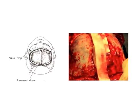 Decompressive Craniectomy Dr Shameej Ppt