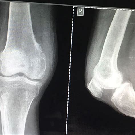 Pdf Osteochondroma Of Distal Femur
