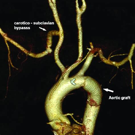 Postoperative Control Three Dimensional Reconstructed Computed Download Scientific Diagram