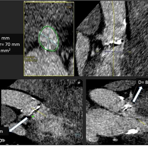 Pci Procedure A Ivus For Rca To Measure The Lesion Size And Length B Download Scientific