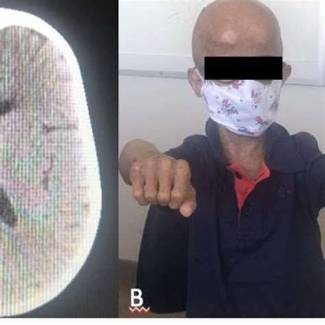 Ct Scan One Day After Surgery Showing A New área Of Ischemia At The Download Scientific