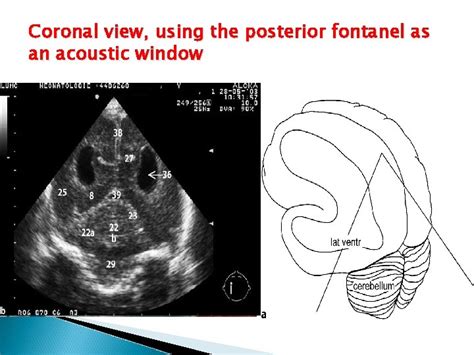 Neonatal Cranial Ultrasound Part 1 Technical Aspect Normal