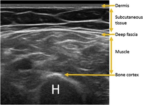 Ultrasound Of Soft Tissue Masses And Fluid Collections Radiologic Clinics